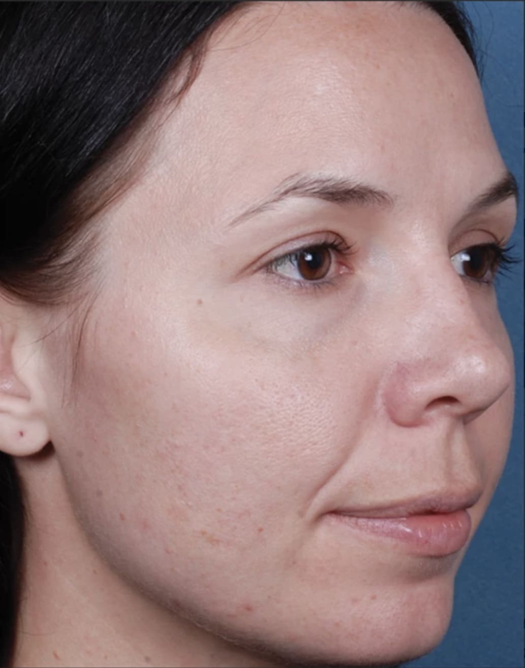 Obagi Blue Peel Radiance for acne scars, lines and wrinkles